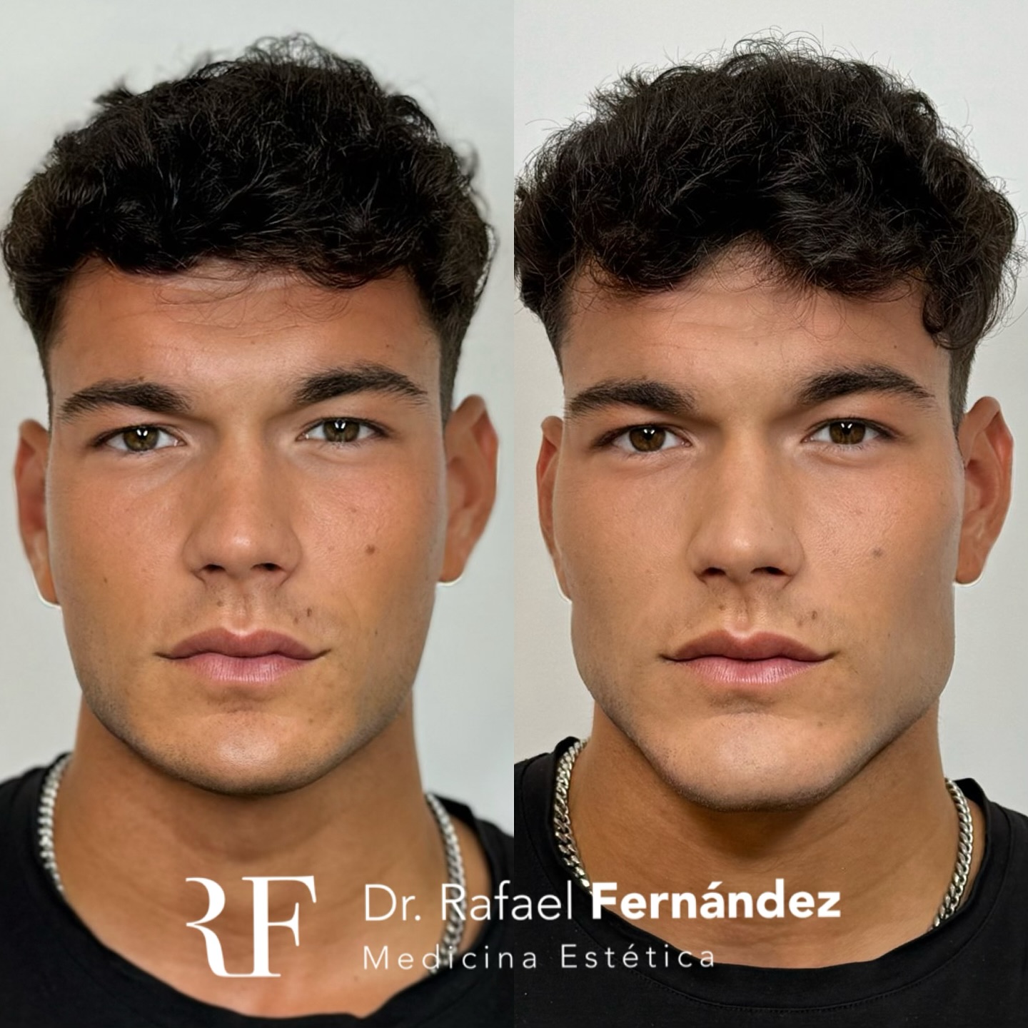 Marcación Mandibular: La Clave para un Perfil Masculino y Atractivo ...